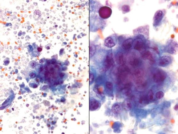 Cerebrospinal Fluid (CSF) Cytology | SpringerLink