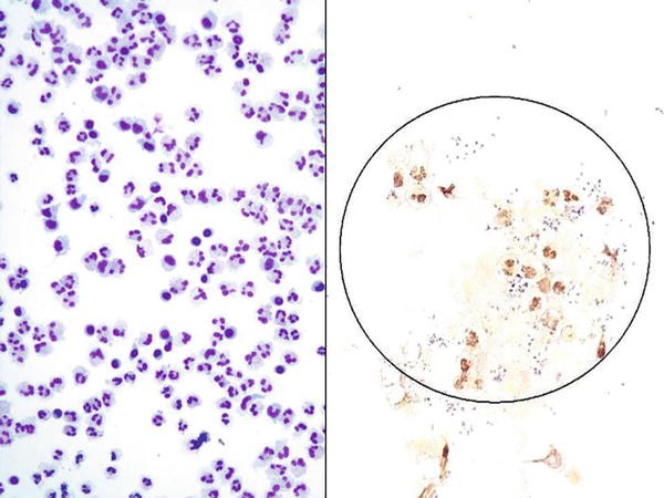 Cerebrospinal Fluid (CSF) Cytology | SpringerLink