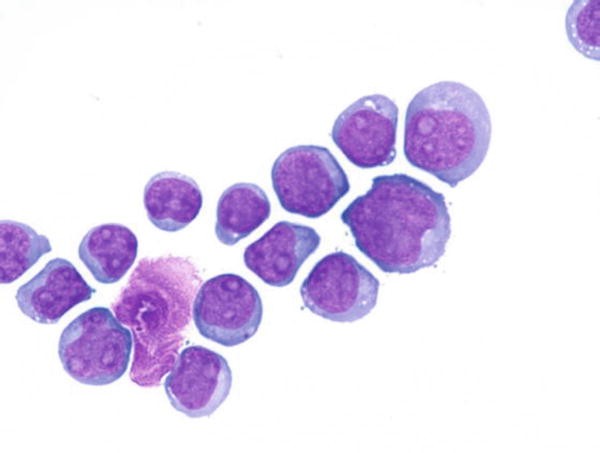 Cerebrospinal Fluid (CSF) Cytology | SpringerLink