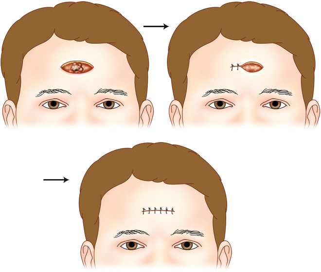 Defect Closure After Lesion Excision of the Face | SpringerLink