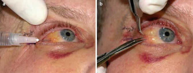 Step-by-Step Treatment of Post-blepharoplasty Chemosis | SpringerLink