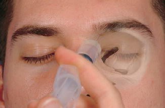 Regional Nerve Blocks in Oculofacial Surgery | SpringerLink