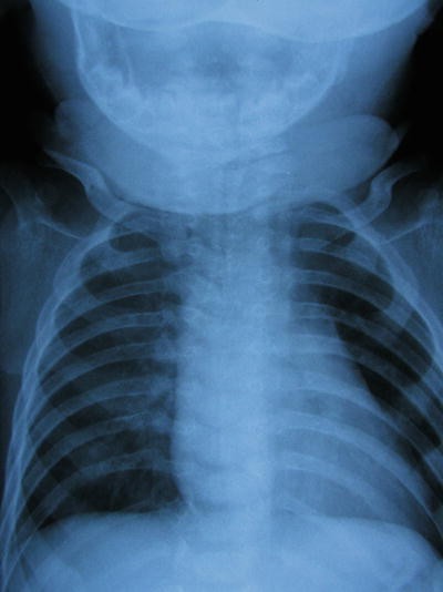Differential Diagnosis of Stridor in the Newborn: Guidelines for a Time ...