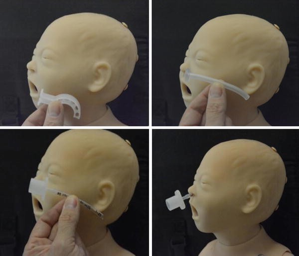 Airway Emergencies in the Neonate: Preparedness at the Bedside ...