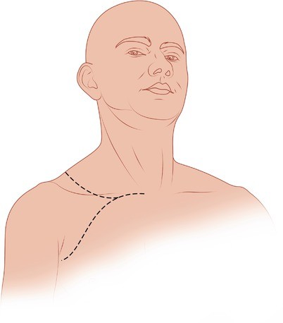 Forequarter Amputation | SpringerLink