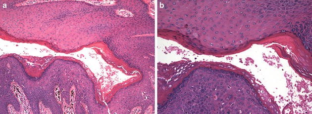 Squamous Intraepithelial Lesions of the Vulva | SpringerLink