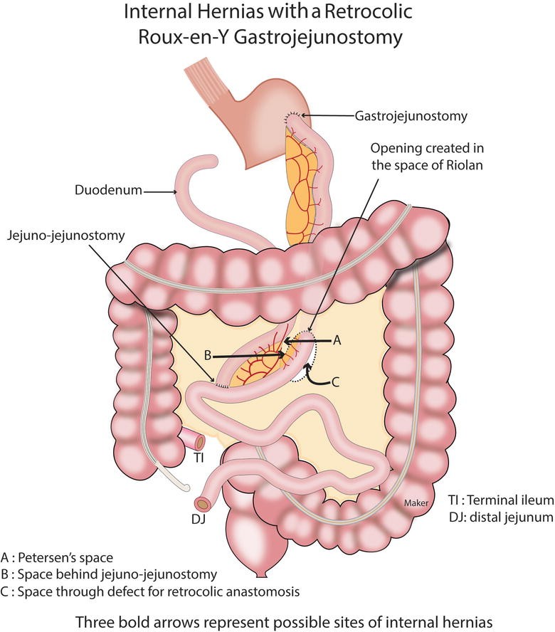Peritoneum, Omentum, and Internal Hernias | SpringerLink