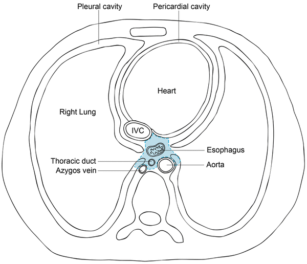 Open Technique for Ivor Lewis Esophagectomy | SpringerLink