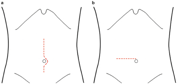Open Right Colectomy | SpringerLink