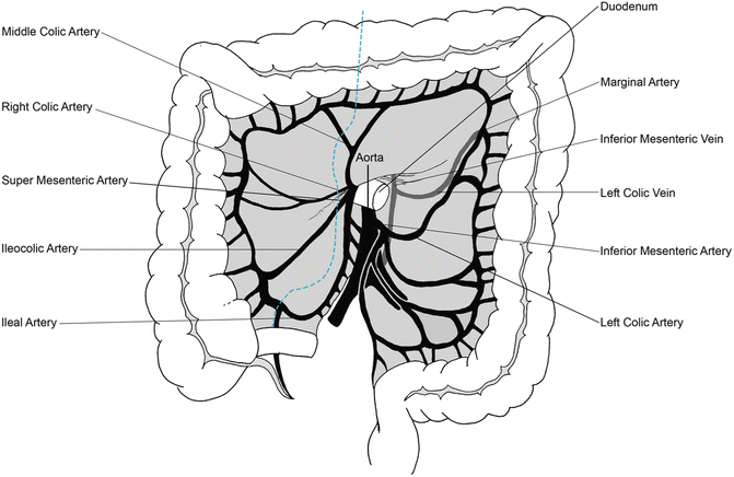 Open Right Colectomy | SpringerLink