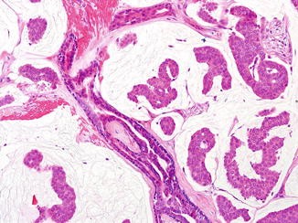 Primary Mucinous Carcinoma of the Skin | SpringerLink