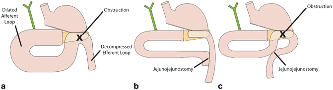 Afferent Loop Syndrome | SpringerLink