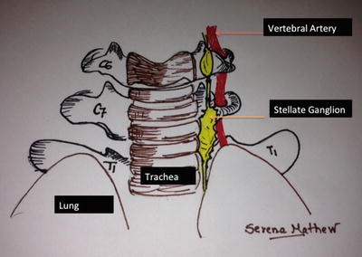 Sympathetic Block Injections | SpringerLink