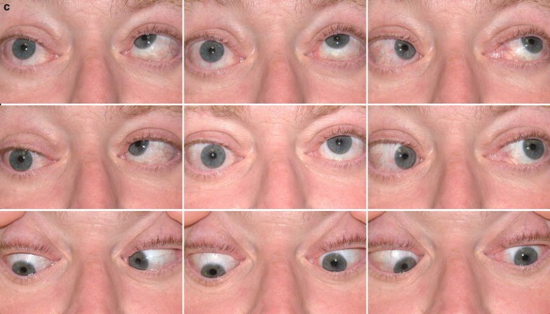 Management of Strabismus in Thyroid Eye Disease | SpringerLink