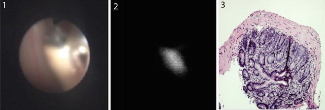 Near-Infrared Fluorescence Endoscopy to Detect Dysplastic Lesions in ...