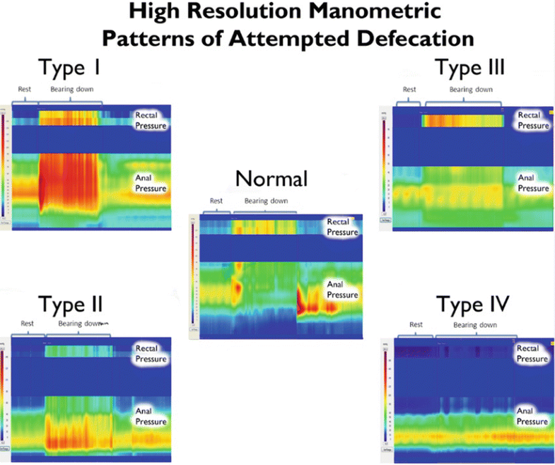 Anorectal Manometry | SpringerLink