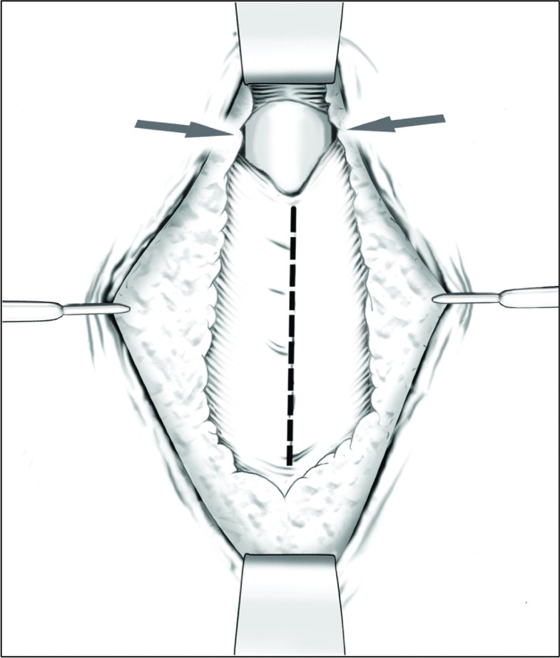 Stricture Excision and Primary Anastomosis for Anterior Urethral ...