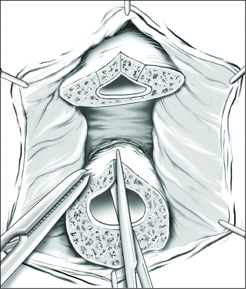 Stricture Excision and Primary Anastomosis for Anterior Urethral ...