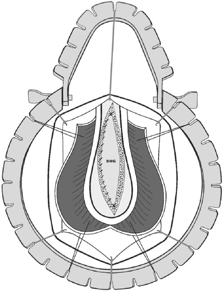 Buccal Mucosal Graft Urethroplasty | SpringerLink