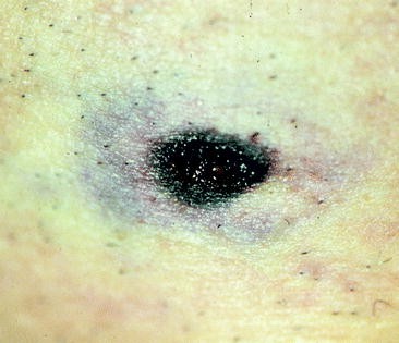 Gunshot Wound Deaths | SpringerLink