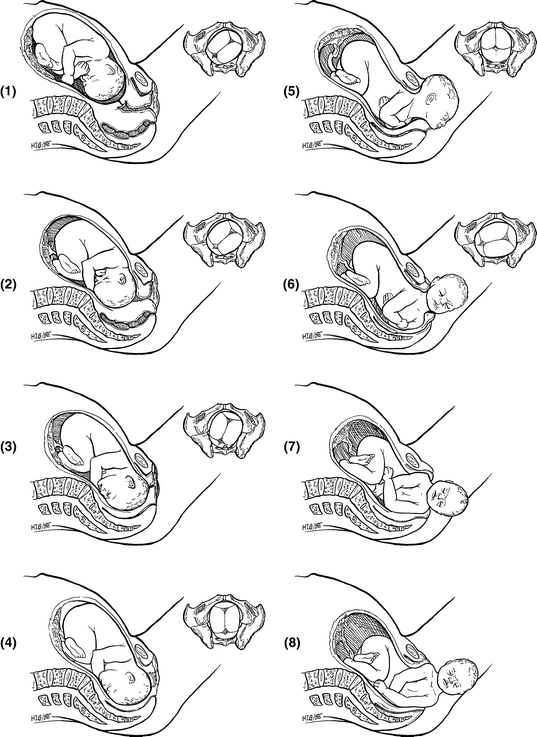 Recognition, Classification, and Management of Shoulder Dystocia: The ...