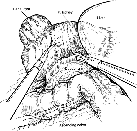 Laparoscopic Renal Cyst Decortication | SpringerLink