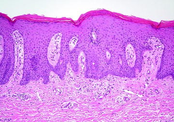 Psoriasiform Dermatitis | SpringerLink