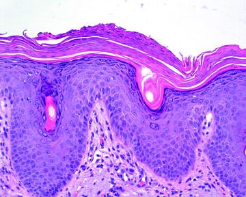 Psoriasiform Dermatitis | SpringerLink