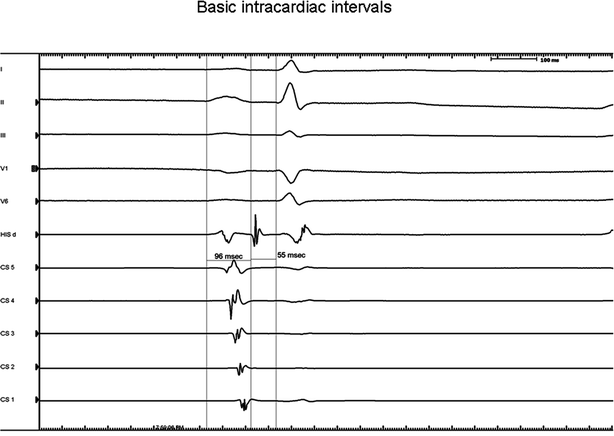 Electrophysiology Study: Indications and Interpretations | SpringerLink