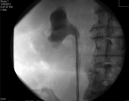 Semirigid Ureteroscopy: The Cleveland Clinic Approach | SpringerLink