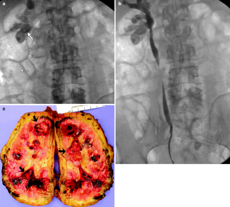 Renal Calculus Disease | SpringerLink