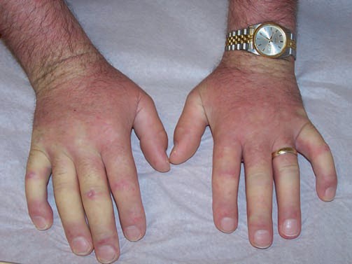 Systemic Sclerosis (Scleroderma) and Raynaud’s Phenomenon | SpringerLink