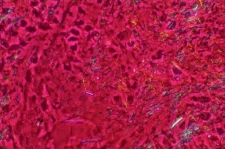 Calcium Pyrophosphate Dihydrate (CPPD) Crystal Deposition Disease ...