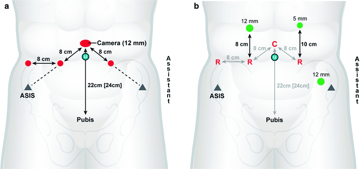 Robotic-Assisted Laparoscopic Anterior Pelvic Exenteration for Bladder ...