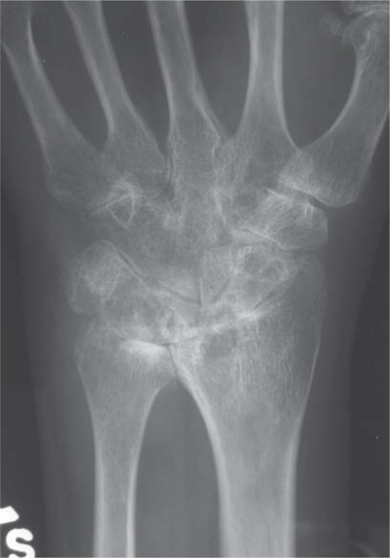 Acquired Diseases of the Hand (Rheumatoid Arthritis and Dupuytren's ...