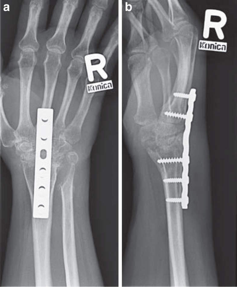 Acquired Diseases of the Hand (Rheumatoid Arthritis and Dupuytren's ...