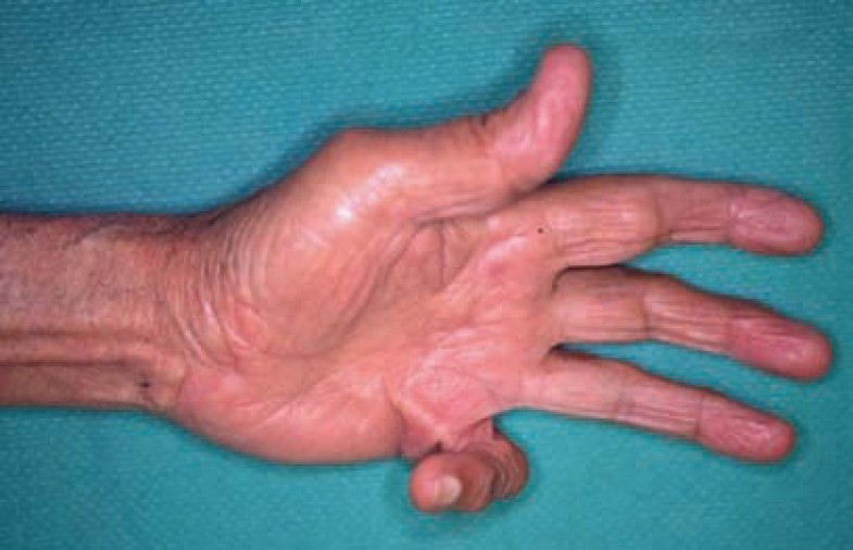 Acquired Diseases of the Hand (Rheumatoid Arthritis and Dupuytren's ...