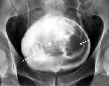 Intraluminal Abnormalities of the Bladder | SpringerLink