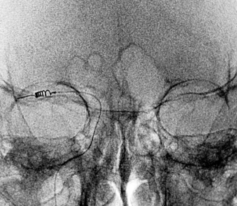 Mechanical Thrombectomy: Emerging Devices and Technologies | SpringerLink