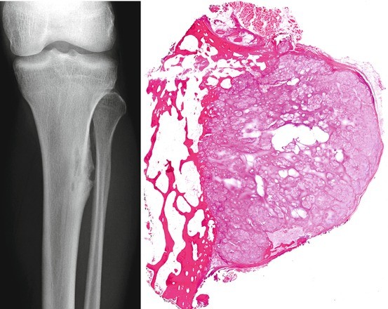 Periosteal Chondroma | SpringerLink