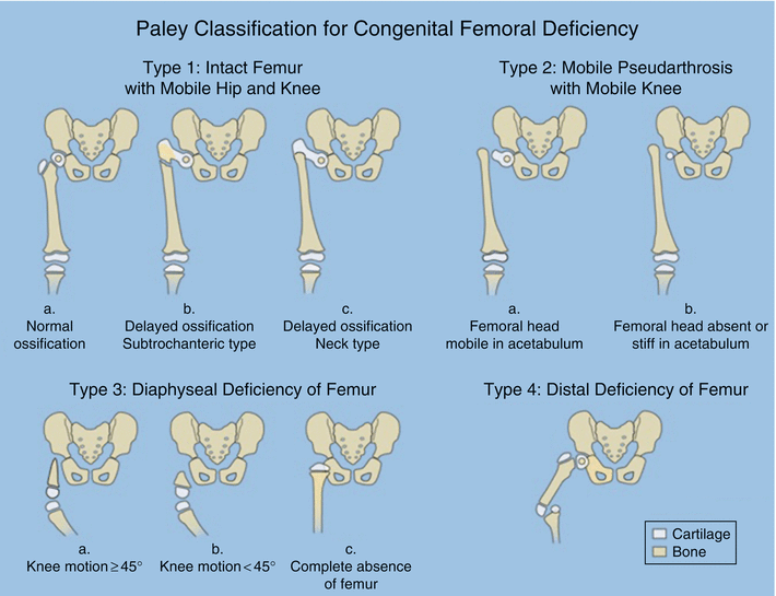 Congenital Femoral Deficiency: Paley Type 1b | SpringerLink