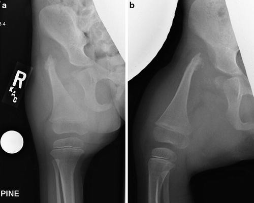 Van Nes Rotationplasty and Hip Reconstruction in the Treatment of ...