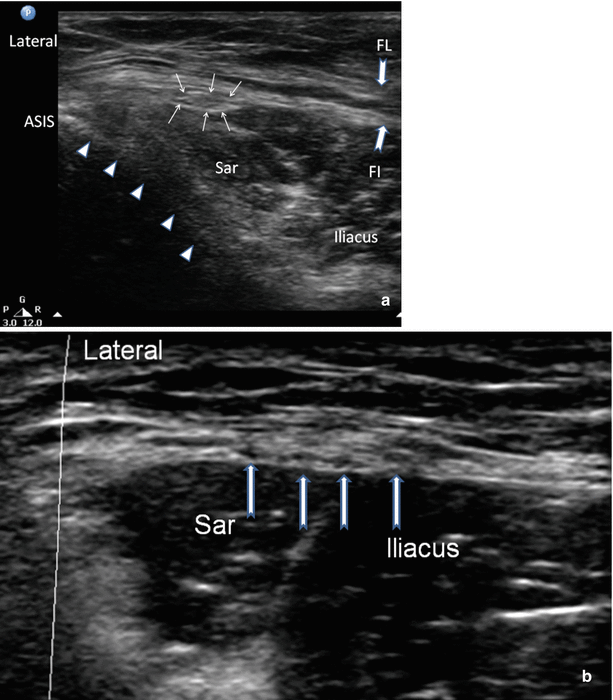 Lateral Femoral Cutaneous Nerve Block | SpringerLink
