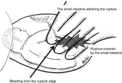 Spontaneous Uterine Rupture | SpringerLink