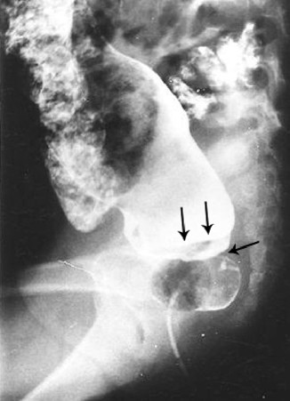 Congenital Rectal Stenosis and Atresia | SpringerLink