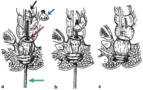 Congenital Rectal Stenosis and Atresia | SpringerLink