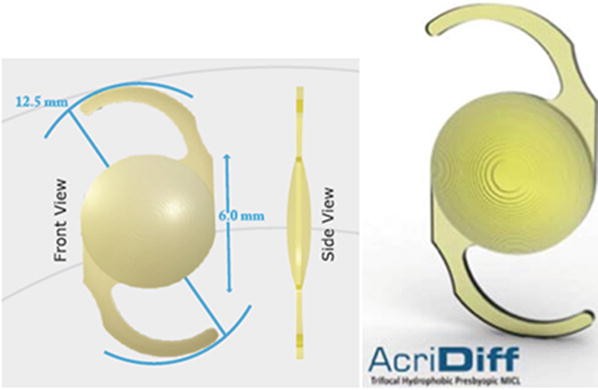 Multifocal Intraocular Lenses: Types and Models | SpringerLink