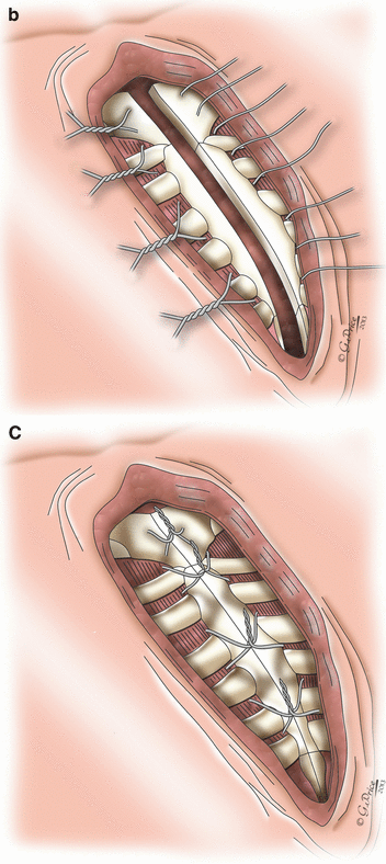 Basic Setup in Cardiac Surgery | SpringerLink