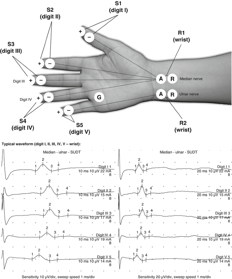 Digit I, II, III, IV, V – Wrist | SpringerLink