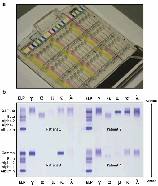 Clinical Protein and Immunofixation Electrophoresis | SpringerLink